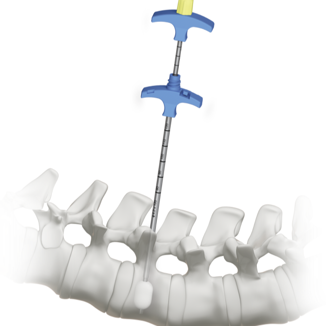 Carlon Kyphoplasty System - Trauhui